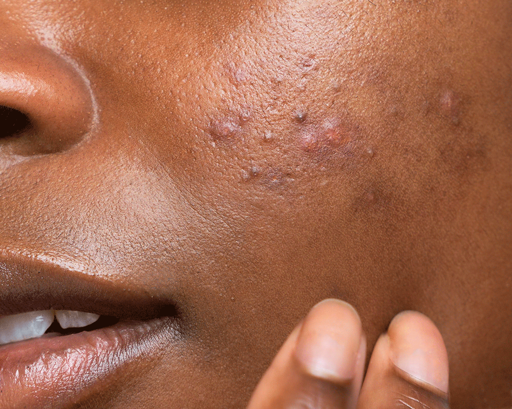 Mighty Patch: How to treat hyperpigmentation based on skin tone | Milled