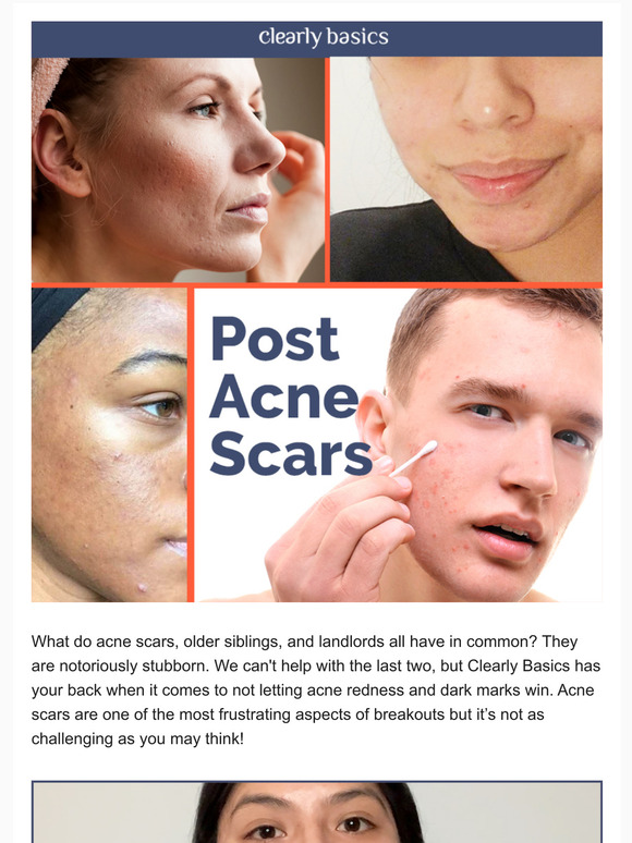 Clearly Basics: Fading, Soothing and Diminishing Scars | Milled