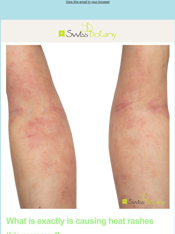 Swiss Botany: What is exactly is causing heat rashes this summer? | Milled