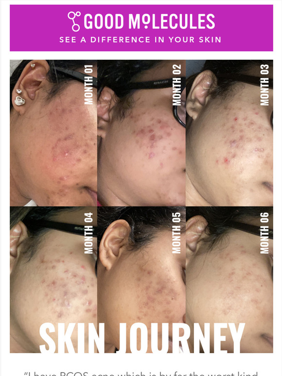 Good Molecules: 3 steps to reduce breakouts and scars | Milled