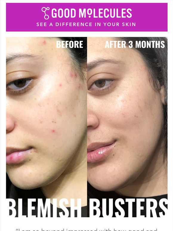 Good Molecules: 3 steps to reduce breakouts | Milled