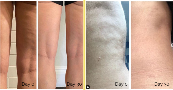 Skinade: Targeted Solutions Cellulite - Before and After pictures | Milled