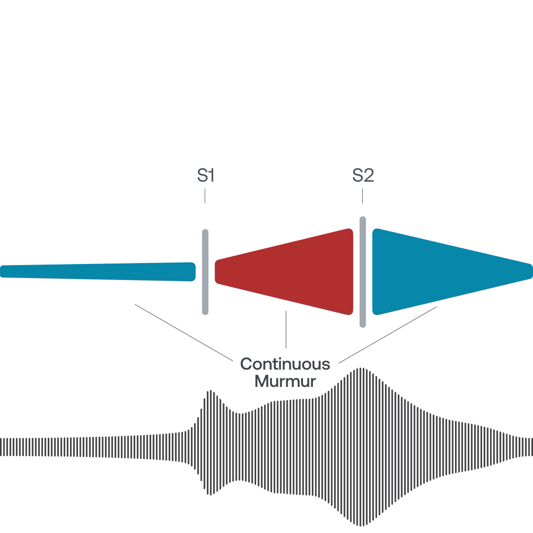 Eko: Understanding Murmur Timing (Part 2) | Milled