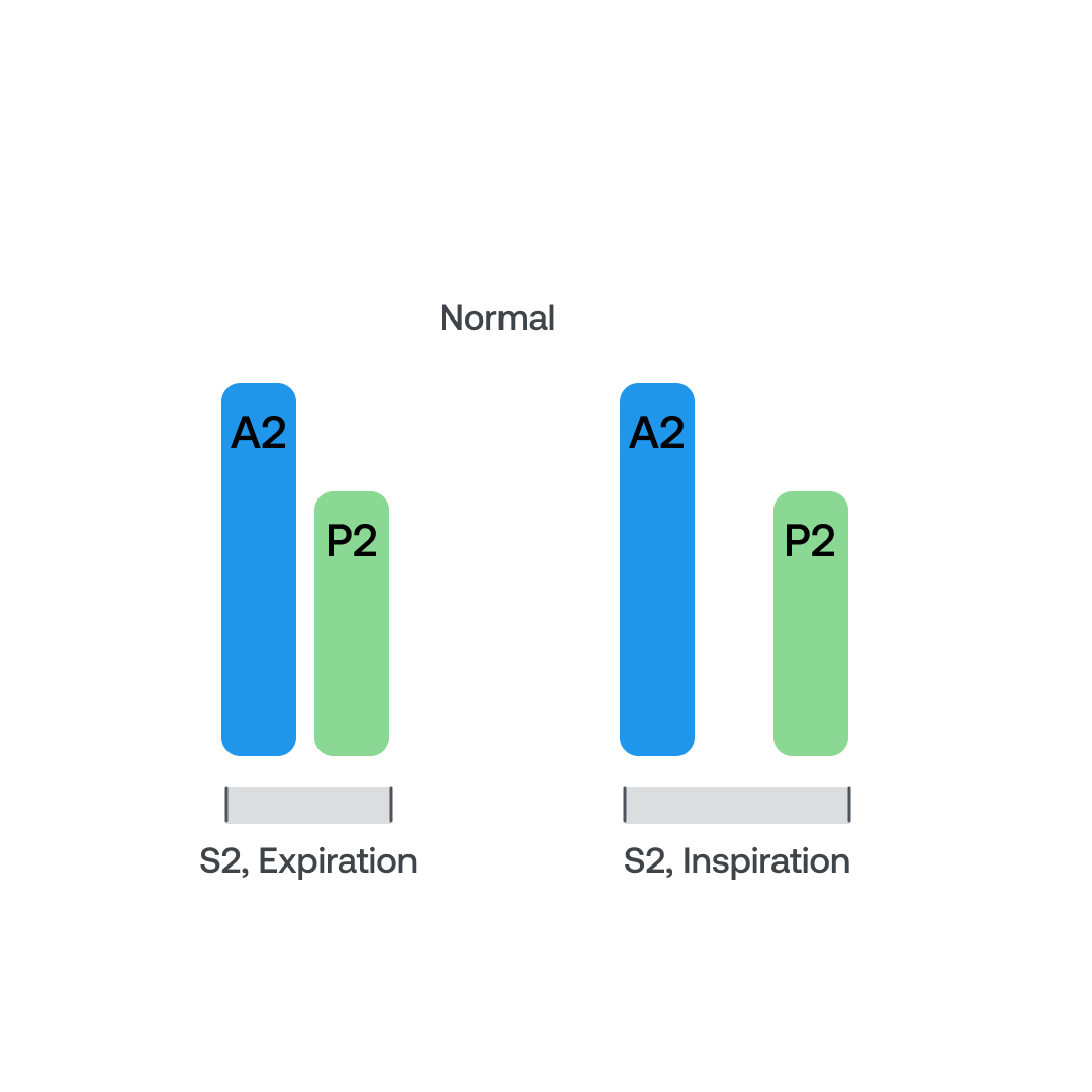 Eko Health: Understanding Heart Sounds (Part 2) | Milled