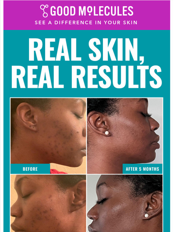 Good Molecules: how to fade blemish scars 😍 | Milled