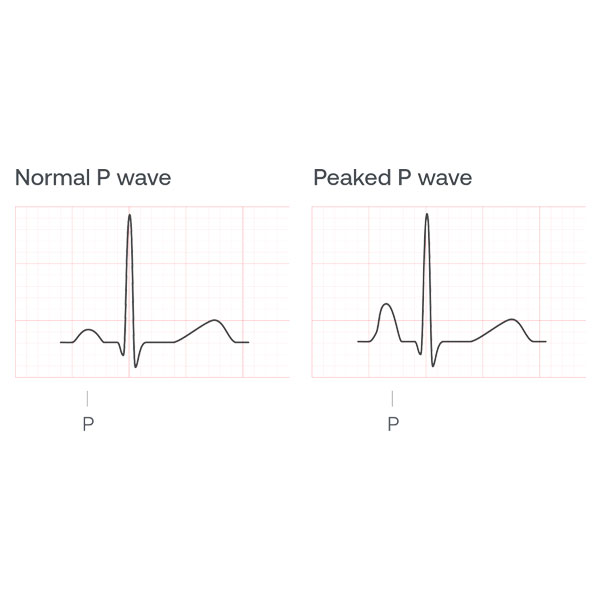 Eko: What is Atrial Depolarization? | Milled