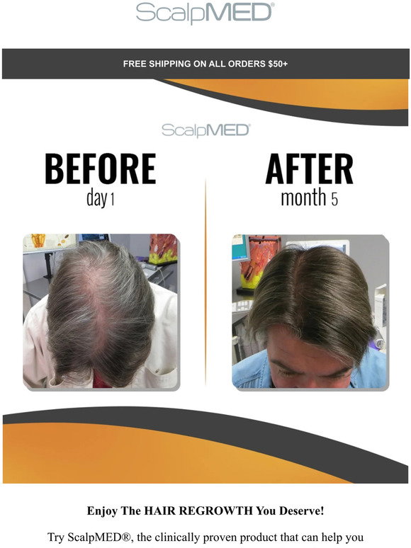 ScalpMed: Enjoy The HAIR REGROWTH You Deserve! | Milled