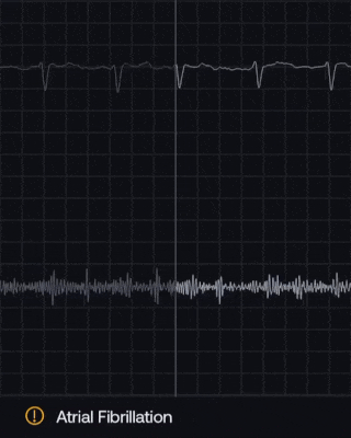 Eko: AFib Awareness Month: Refresh Your AFib Knowledge | Milled