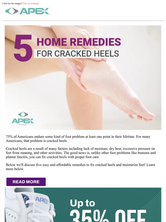 Apex Foot: 5 Home Remedies for Cracked Heels | Milled