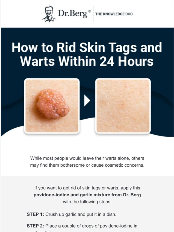 Dr. Berg: Say Goodbye to Skin Tags and Warts | Milled