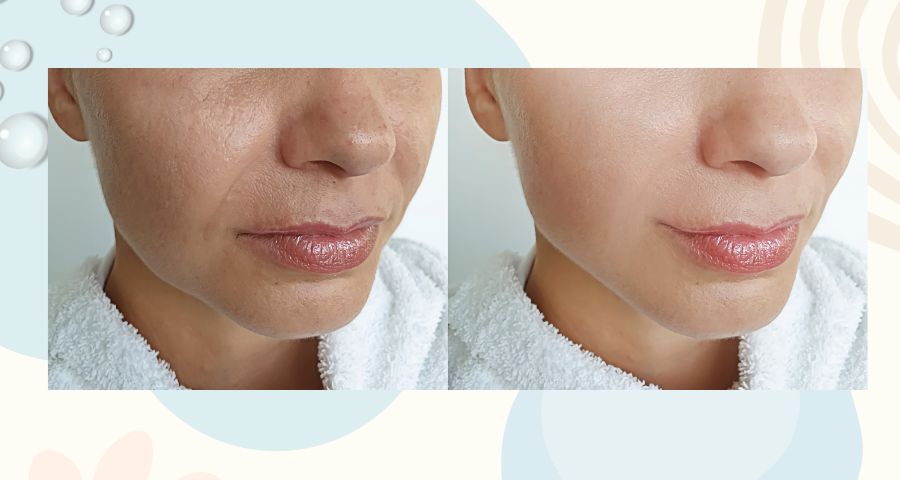 Perfect Image: How to Get Rid of Cellulite on Face | Milled