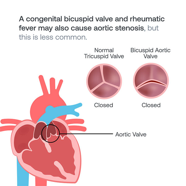 Eko: Do You Know the Most Common Heart Valve Disease? | Milled