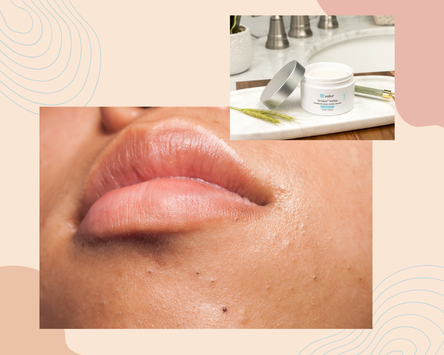 Perfect Image: Say Goodbye to Blackheads with Perfect Image! | Milled