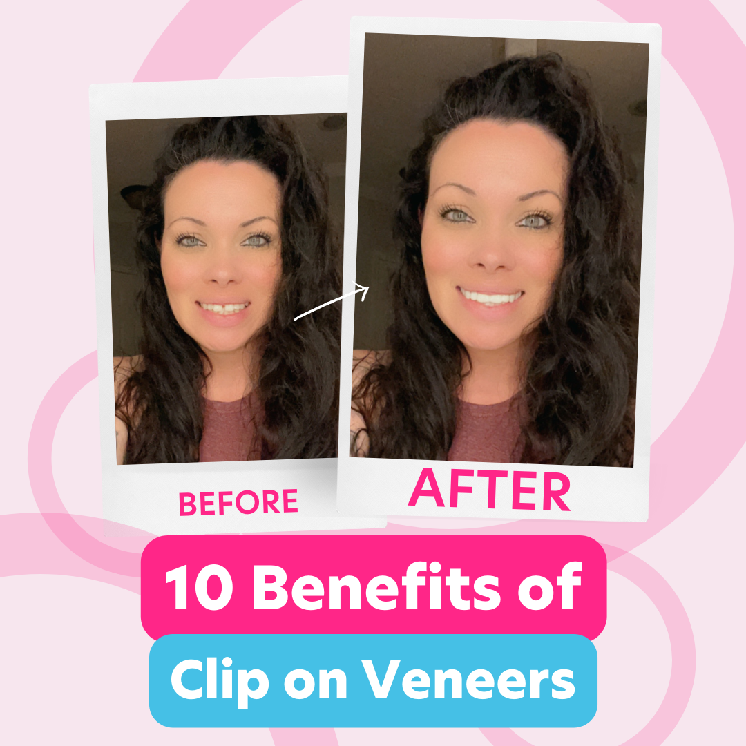 INSTAsmile: — 10 Reasons YOU Should get Clip-On Veneers 😍 | Milled