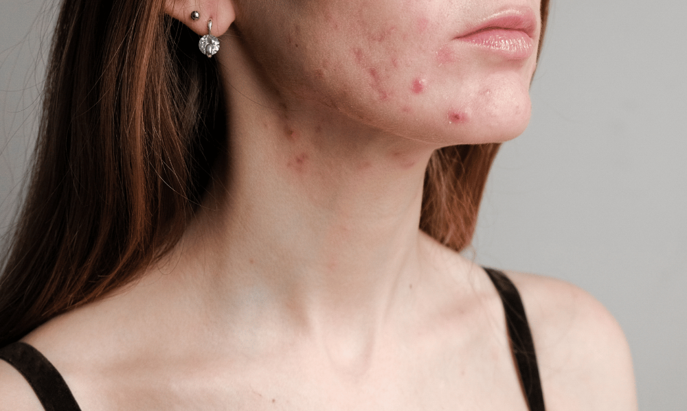 Epicuren Discovery Fungal Acne Vs Closed Comedones 🤷🏻♂️ Whats The