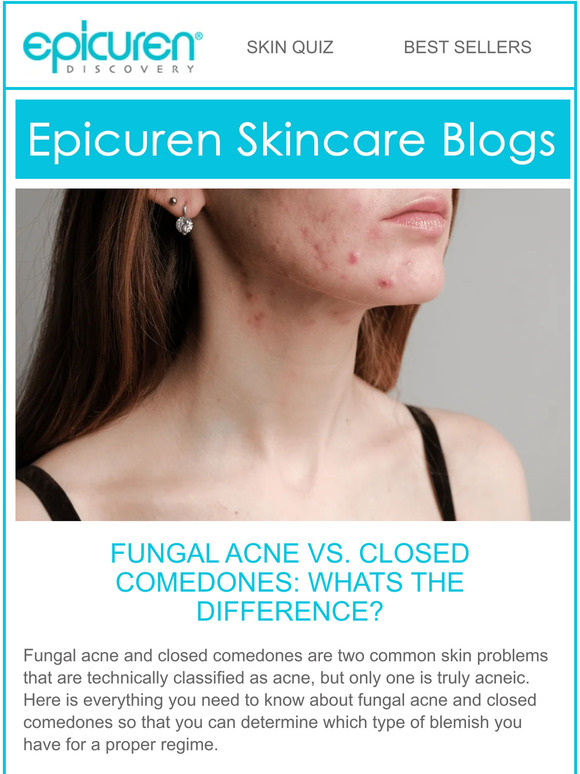 Epicuren Discovery Fungal Acne Vs Closed Comedones 🤷🏻♂️ Whats The