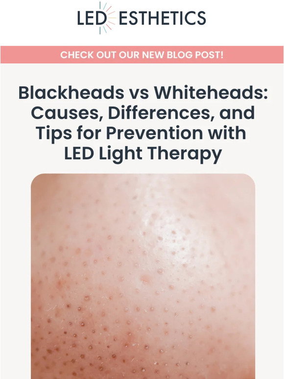 LED Esthetics: Blackheads vs Whiteheads: Causes, Differences, and Tips ...