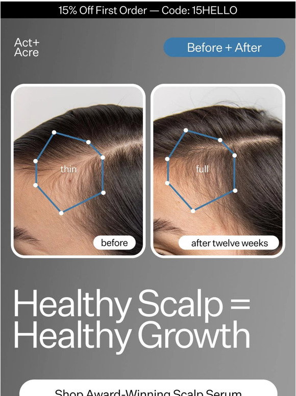 Act + Acre: Meet Hair Growth Scalp Serum | Milled