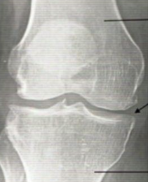 DeRose Health: New “Knee Candy” Rejuvenates Stiff, Achy Joints | Milled