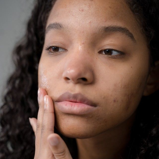 CLn Skin Care: Understanding Skin Purging & Products to Combat It | Milled