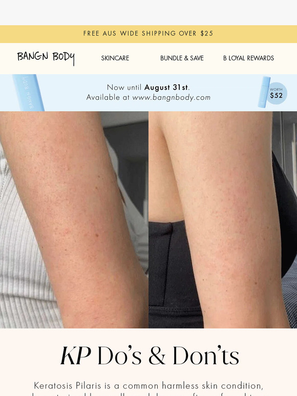 Bangn Body: Got Bumps on your arms? Body Acne? Treat KP Now! | Milled