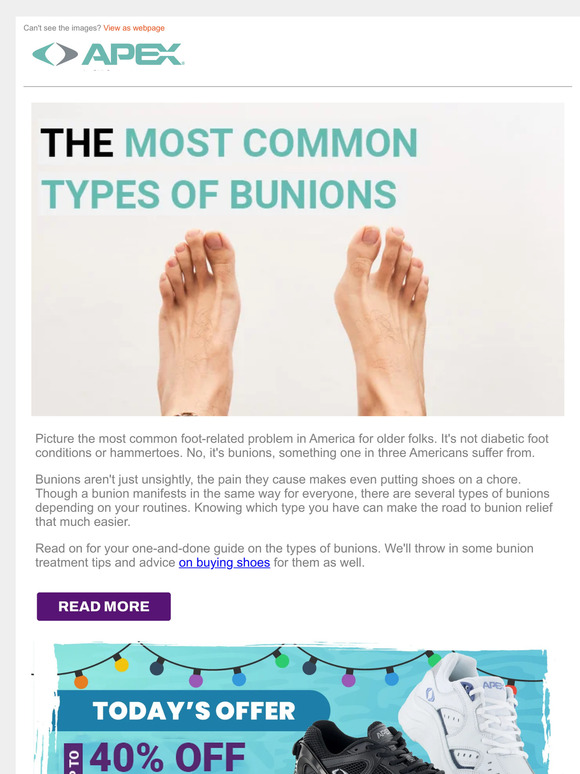 Apex Foot: Bunions can be painful. Here are the most common types. | Milled
