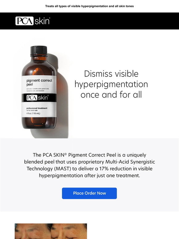 PCA Skin: Introducing NEW Pigment Correct Peel | Milled