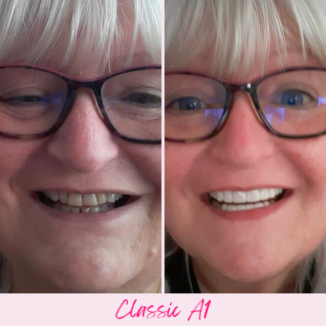 INSTAsmile: Hey —, Check Out These A1 Shade Smile Transformations 🤩 ...