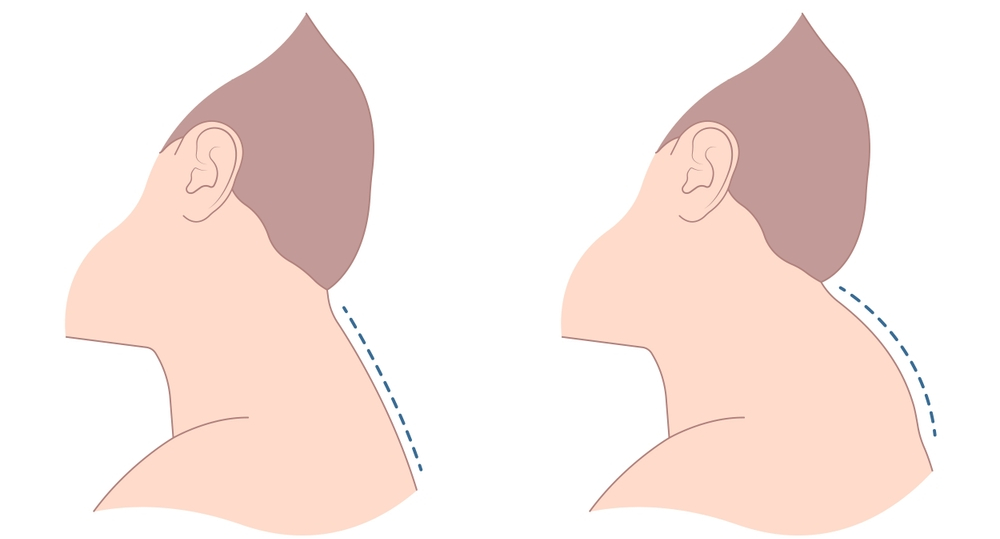 Percko: La bosse de bison : Que faire ? | Milled