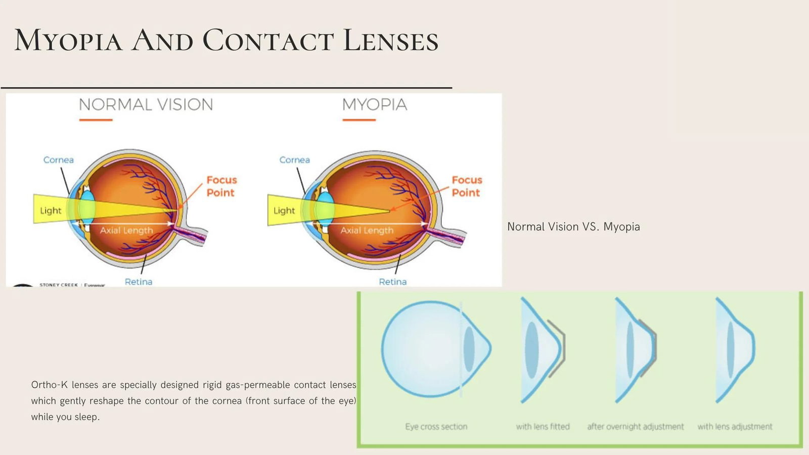 Unicoeye: 👀The Role of Contact Lenses in Myopia Control👀 | Milled