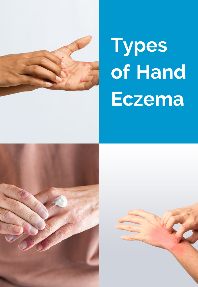 Soteri Skin: Eczema on hands? | Milled