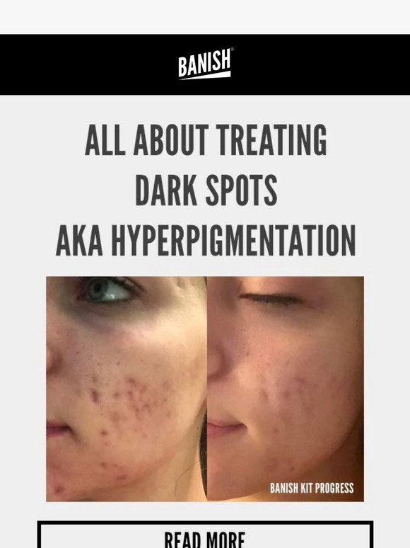 Banish: All About Dark Spots & Ways To Treat It! | Milled