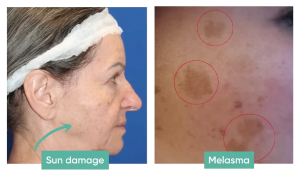Karam MD: KaramMD Journal: How to Treat & Manage Melasma The Right Way ...