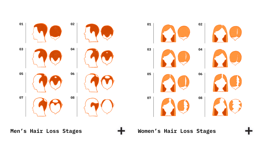 Scandinavian Biolabs: Male vs. female hair loss | Milled