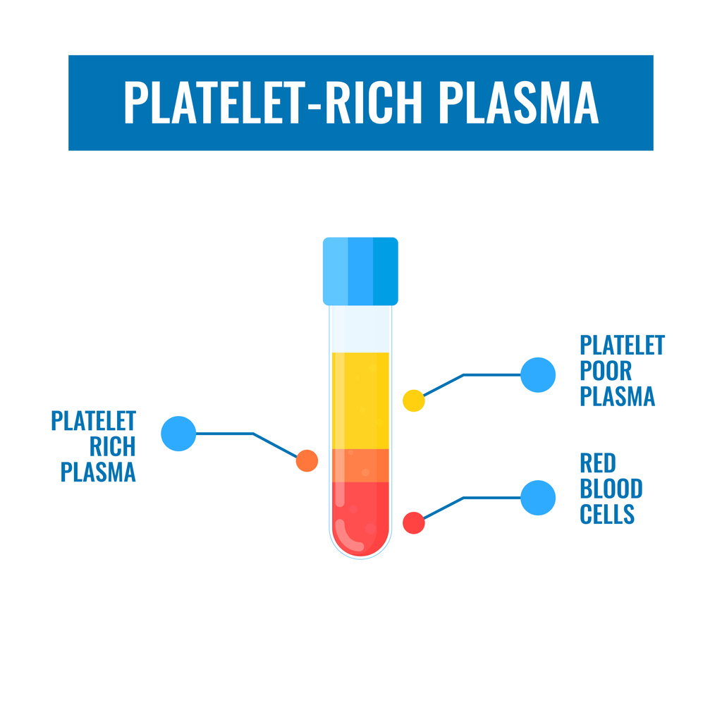 PainScale: What Are Platelet Rich-Plasma Injections? | Milled