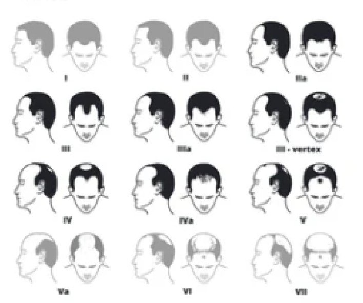 Hairmax: Androgenetic Alopecia Explained: What Every Man Should Know ...