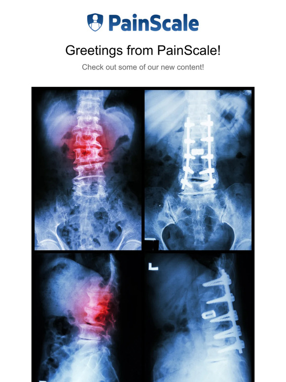 PainScale: Types of Spinal Fusion Surgeries | Milled