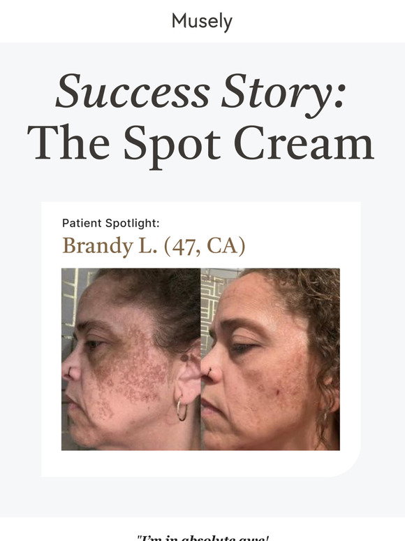 Musely: Success Story: How She Faded Her Melasma in 30 Days! 👏 | Milled
