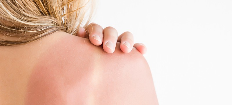 Dr. Axe: 5+ Natural Ways to Get Sunburn Relief | Milled